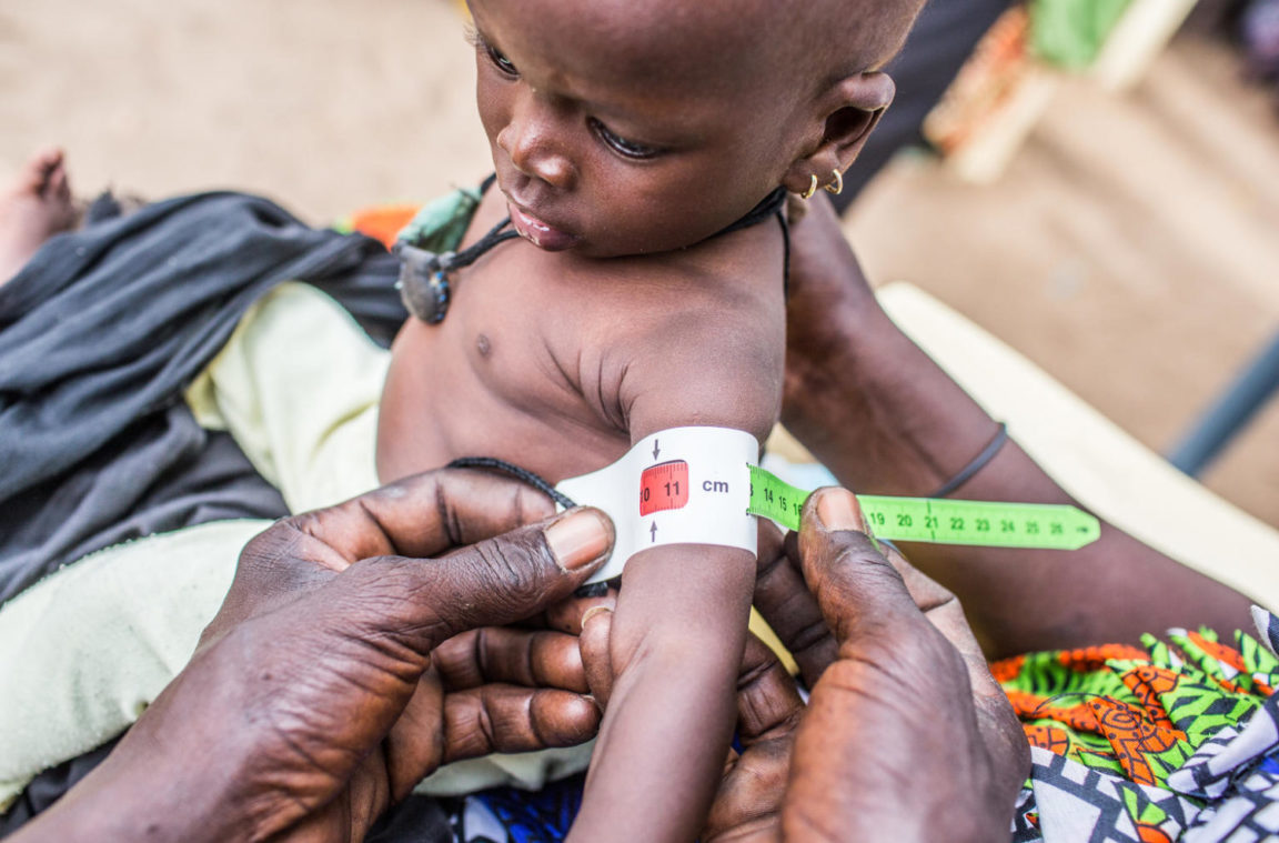 10,000 More Children Can Die This Year From Malnutrition Amid Pandemic ...